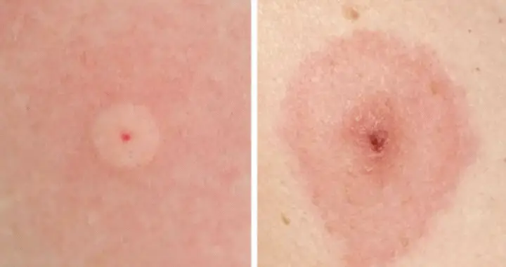 How To Identify 10 Of The Most Common Bug Bites – Know What Bit You ...
