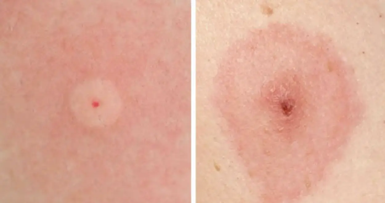 How To Identify 10 Of The Most Common Bug Bites – Know What Bit You ...